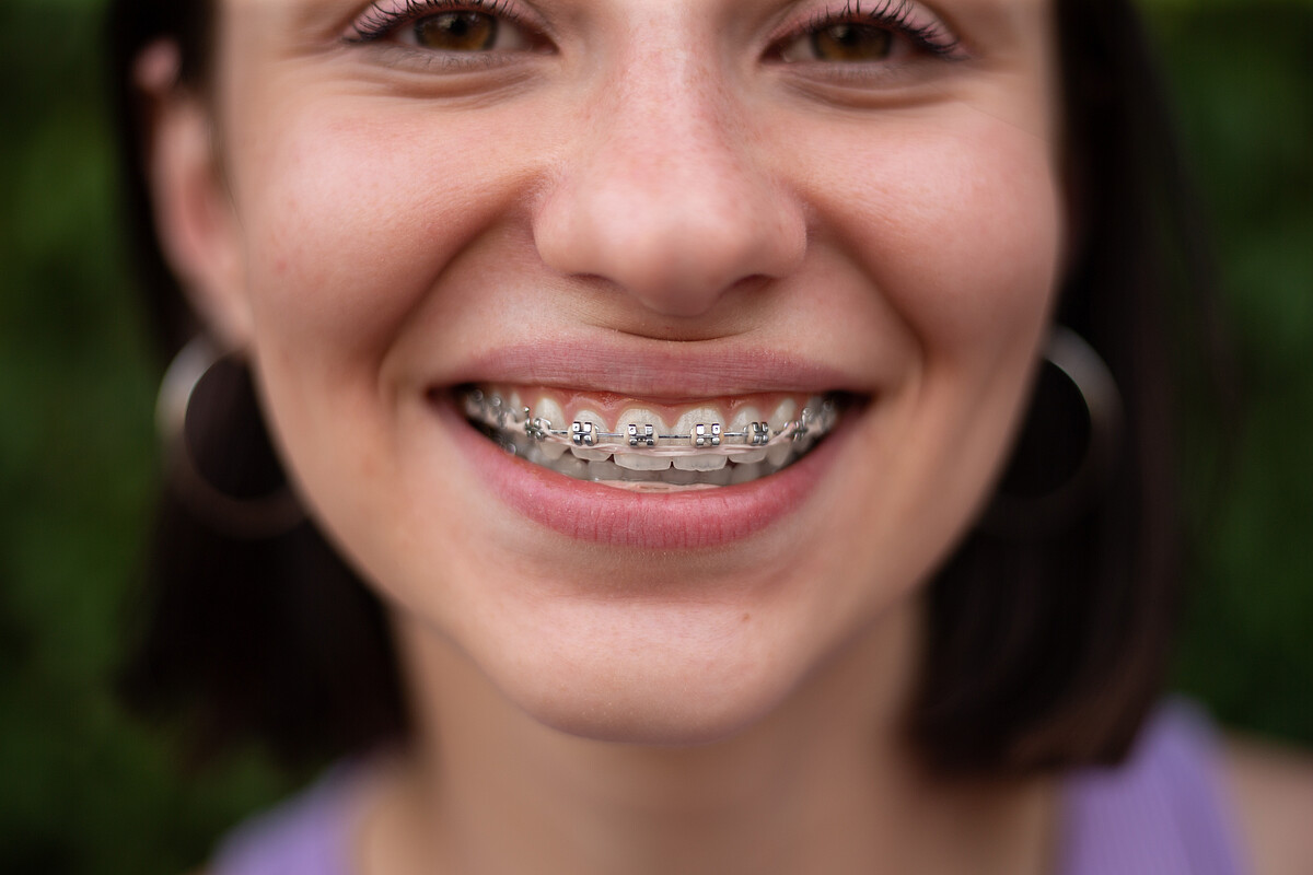 GIBT ES VERSCHIEDENEN ARTEN VON BRACKETS FÜR ZAHNSPANGEN ...
